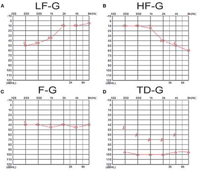Tympanic Membrane Perforation Audiogram