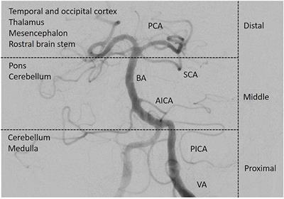 Midbrain Stroke Syndromes