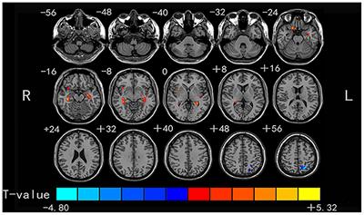Frontiers | Altered Functional Brain Network in Systemic Lupus ...