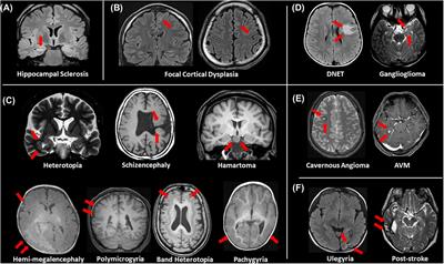 Frontiers | Making the Invisible Visible: Advanced Neuroimaging ...