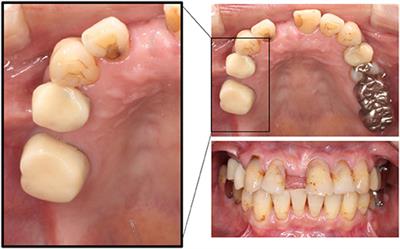 Frontiers | Case Report: Iatrogenic Dental Progress of Phantom Bite ...