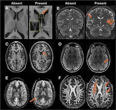 Concussion Brain Compared To Normal