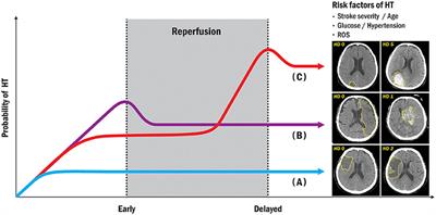 Frontiers | Hemorrhagic Transformation After Ischemic Stroke ...