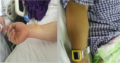 Frontiers | Comparison of the Efficacy of Two Elastic Bandages for ...