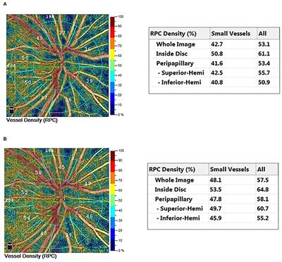 Frontiers | Improved Retinal Microcirculation After Cardiac Surgery in ...