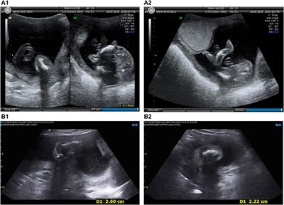 Osteogenesis Imperfecta Type 2 Ultrasound