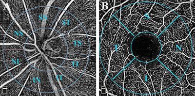 Frontiers | Change of Retinal Vessel Density After Lowering Intraocular ...