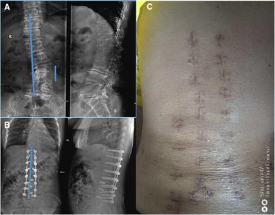 Frontiers | Case Report: Adult degenerative scoliosis in two patients ...