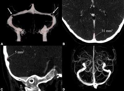 Frontiers | Transverse Sinus Stenosis in Venous Pulsatile Tinnitus ...