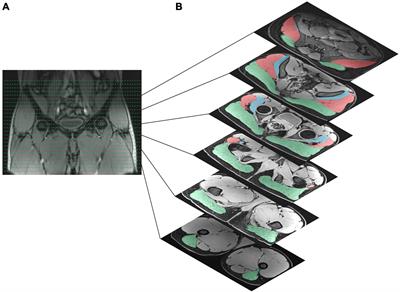 Frontiers | Gluteal Muscle Atrophy and Increased Intramuscular Lipid ...