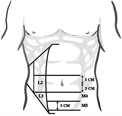 Frontiers | Non-closure of the Free Peritoneal Flap During Laparoscopic ...