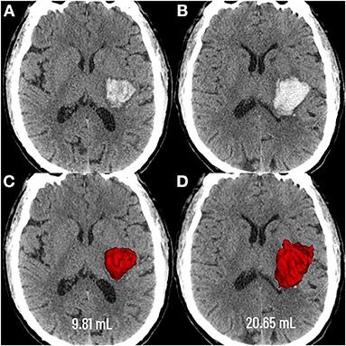 Frontiers | Association Between Anatomical Location and Hematoma ...