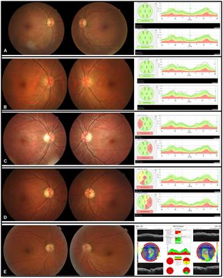 Ethambutol Toxicity Eye Screening Clipart