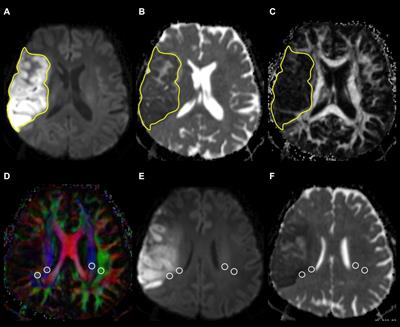 Frontiers | Glymphatic Dysfunction in Patients With Ischemic Stroke