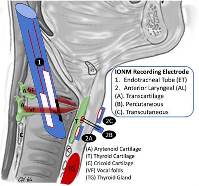 Endotracheal Intubation Vocal Cords