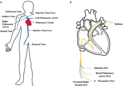Pulmonary Artery Catheter