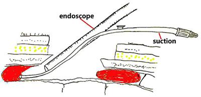 Frontiers | Efficacy of Neuroendoscopic Treatment for Septated Chronic ...