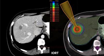 Frontiers | Dosimetric Comparison of Intraoperative Radiotherapy and ...