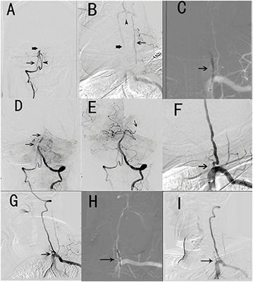 Frontiers | A Case Series and Literature Review of Vertebral Artery ...