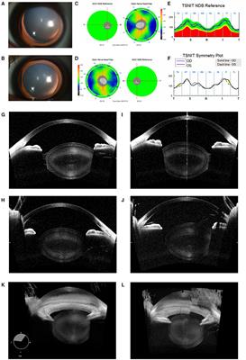 Frontiers | Lens Biometry in Congenital Lens Deformities: A Swept ...