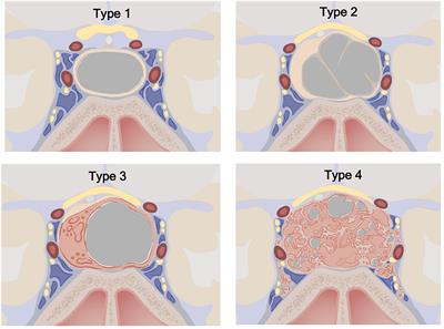 Frontiers | Cyst Type Differentiates Rathke Cleft Cysts From Cystic ...