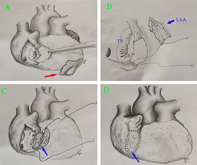 Frontiers | Case Report: Reconstruction of the Right Atrium With the ...