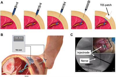 Frontiers | Augmented Transcutaneous Stimulation Using an Injectable ...