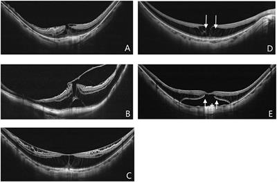 Frontiers | Vitreomacular Interface Abnormalities in Myopic ...