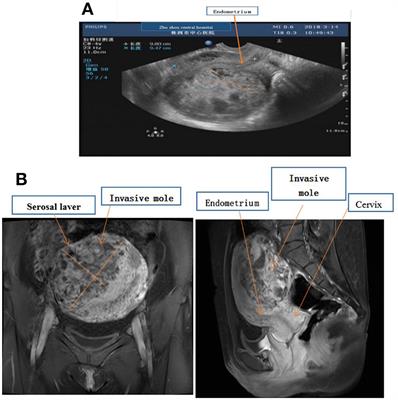 Frontiers | Invasive Mole Resulting in Uterine Rupture: A Case Report