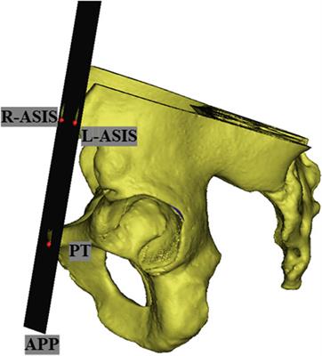 Frontiers | Acetabular Revision Arthroplasty Based on 3-Dimensional ...