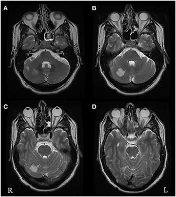 Frontiers | Case Report: Transformation of Visual Snow Syndrome From ...