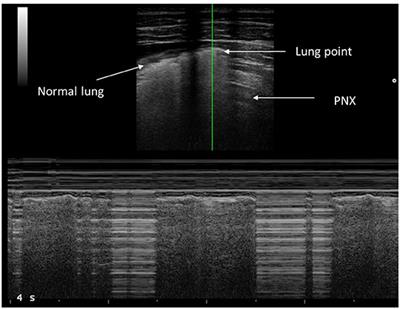 Frontiers | Lung Ultrasound to Detect Pneumothorax in Children ...