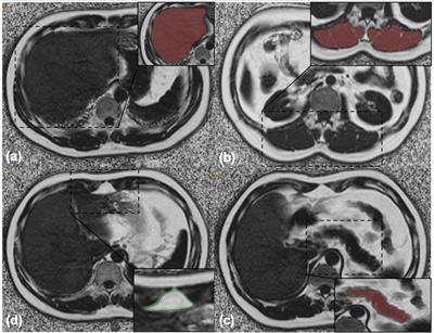 Frontiers | Magnetic Resonance Imaging Assessment of Abdominal Ectopic ...