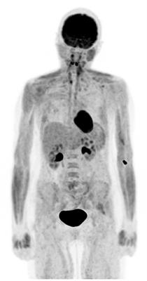 Normal Pet Scan Images
