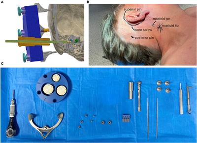 Frontiers | Minimally Invasive Cochlear Implantation: First-in-Man of ...