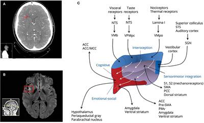 Frontiers | Case Report: Right Insular Stroke Causing Simultaneous ...