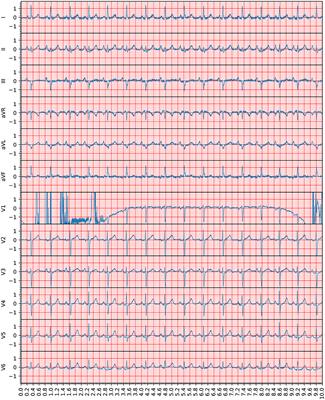 Frontiers | ECGAssess: A Python-Based Toolbox to Assess ECG Lead Signal ...