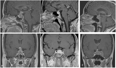 Frontiers | Atypical Teratoid Rhabdoid Tumor: A Possible Oriented ...