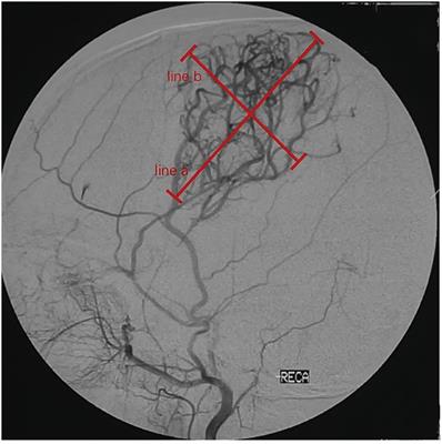 Frontiers | Recognition of the Effect of Indirect Revascularization for ...