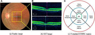 Frontiers | Thickened Retinal Nerve Fiber Layers Associated With High ...