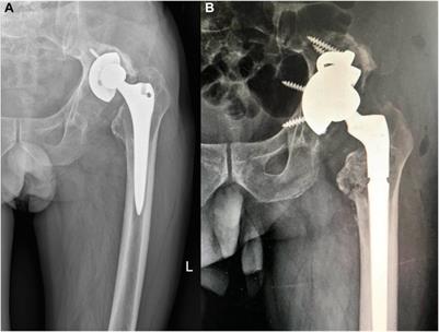 Frontiers | Revision total hip arthroplasty using a fluted, tapered ...