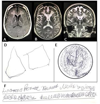 Frontiers | Uterus infantilis: a novel phenotype associated with AARS2 ...
