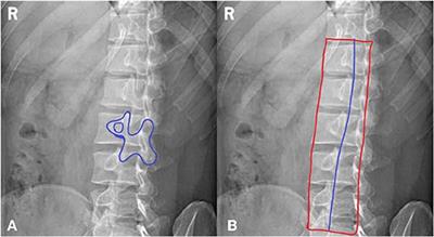 Lateral Lumbar Spine Xray