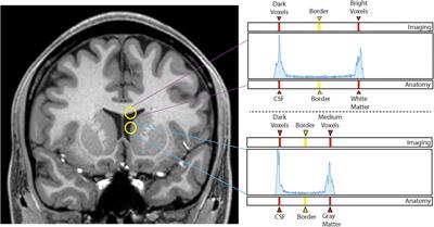 Frontiers | Anatomically curated segmentation of human subcortical ...