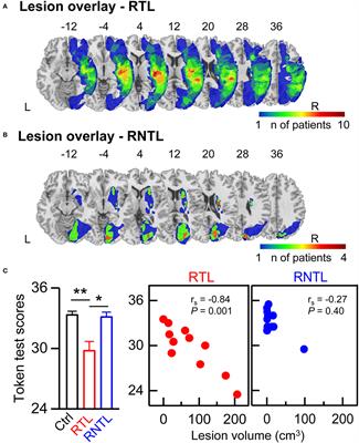 Frontiers | Brain hemispheres with right temporal lobe damage swap ...
