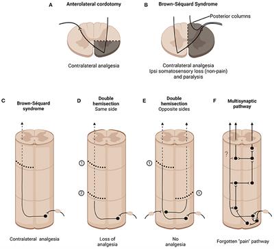 Frontiers | History of Spinal Cord “Pain” Pathways Including the ...