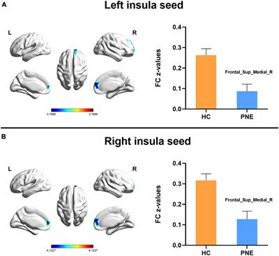 Frontiers | Altered resting-state functional connectivity of insula in ...