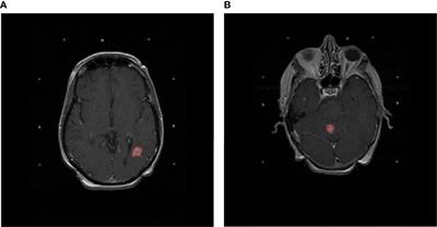 Frontiers | Predicting Adverse Radiation Effects in Brain Tumors After ...