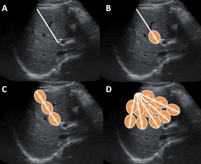 Frontiers | Study of ultrasound-guided percutaneous microwave ablation ...