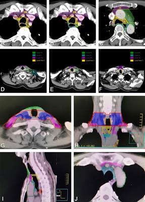 Frontiers | Treatment outcomes of 156 patients with cervical esophageal ...